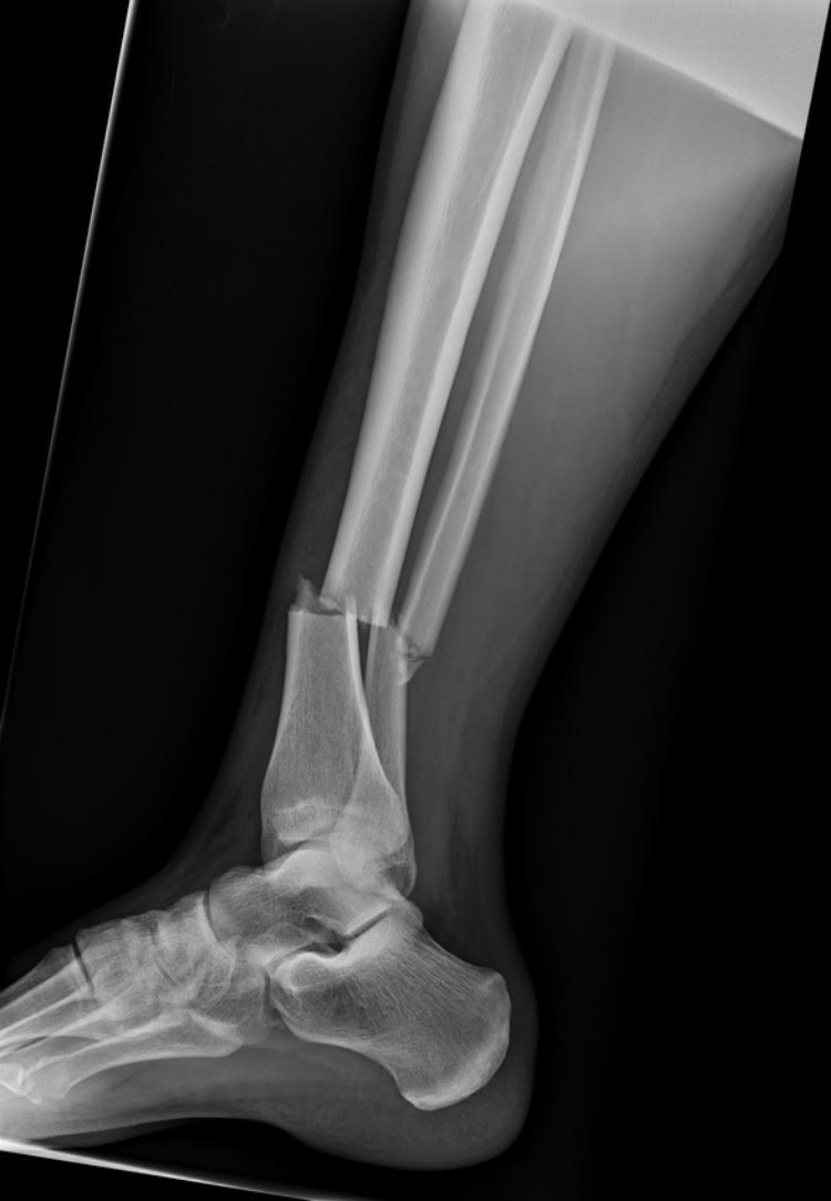 Scottsdale Injury Lawyers Advances Personal Injury Case for Canadian ...